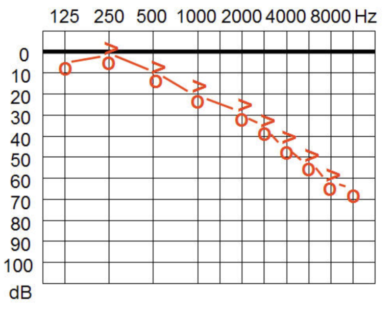 Schallempfindungs-Schwerhörigkeit • einfach erklärt