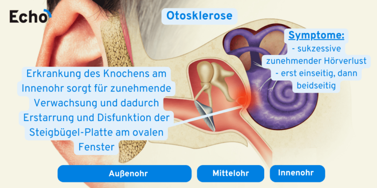 13 häufigste Ohrenerkrankungen👂🏼 [Ursachen, Symptome & Tipps] - Echo